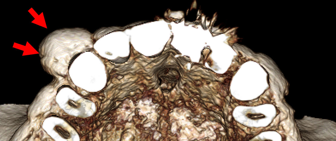 37-year-old man with bony protuberance on buccal side of maxilla ...