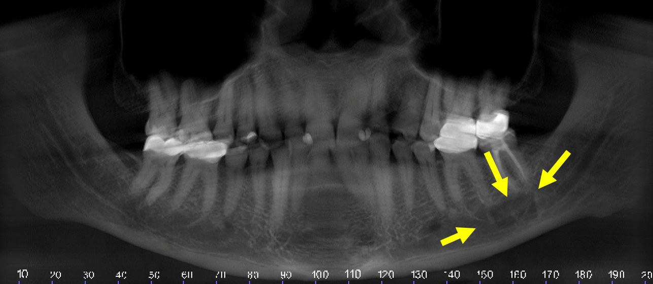 42-year-old woman with radiolucency on mandible - DrBicuspid